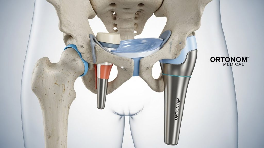 Bipolar Hip - Ortonom Medical